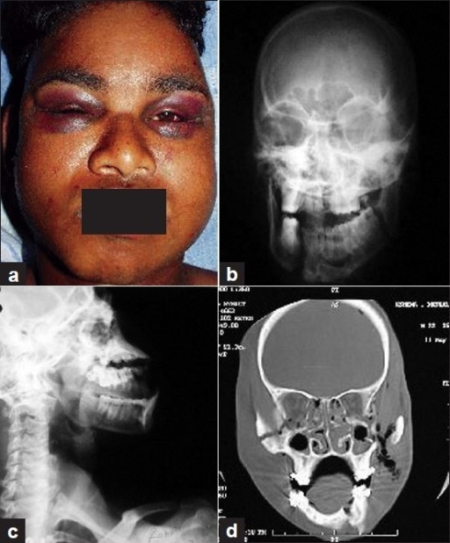 Maxillofacial trauma - WikEM