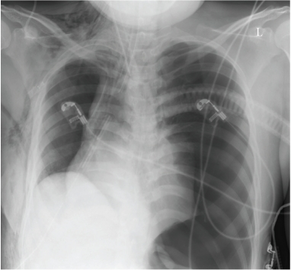 Chest x-ray interpretation - WikEM