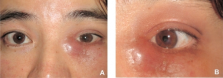 Dacryocystitis - WikEM