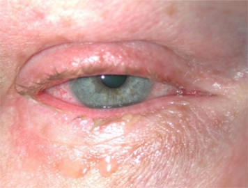 Conjunctivitis - WikEM