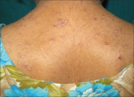 Pruritic papular eruption of HIV - WikEM