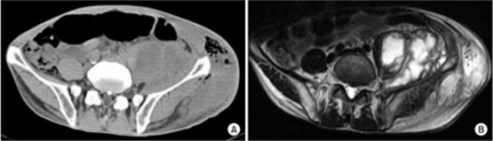 Psoas abscess - WikEM
