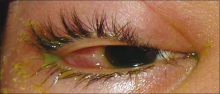 Dacryoadenitis - WikEM