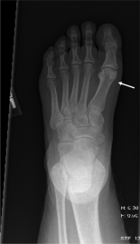 Foot and toe fractures - WikEM