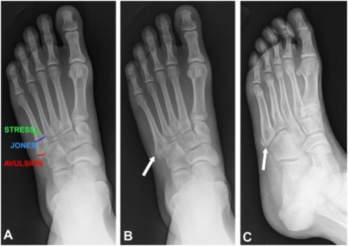 Foot and toe fractures - WikEM