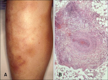 Superficial thrombophlebitis - WikEM