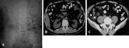 Body packing - WikEM