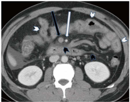 Mesenteric vein thrombosis - WikEM