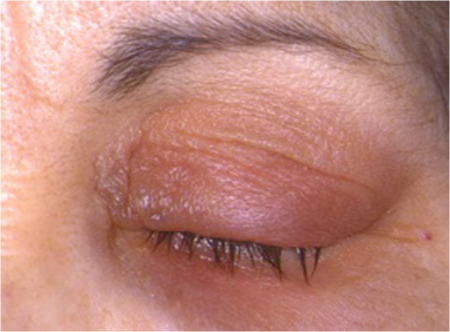 Keratoconjunctivitis - WikEM