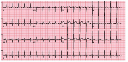 Atrial tachycardia - WikEM