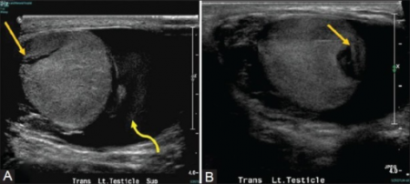 Testicular rupture - WikEM