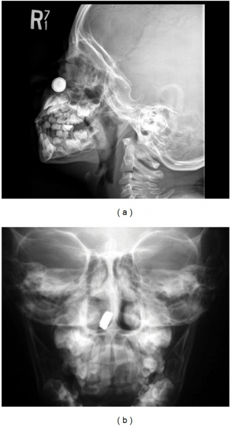 Nasal foreign body - WikEM
