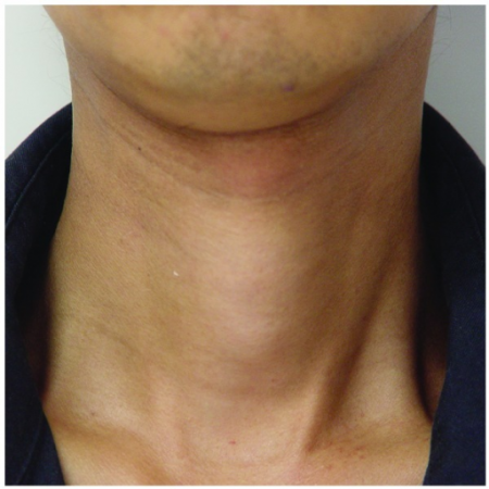 Hyperthyroidism - WikEM
