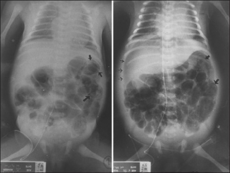 Necrotizing enterocolitis - WikEM
