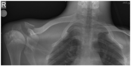 Sternoclavicular dislocation - WikEM