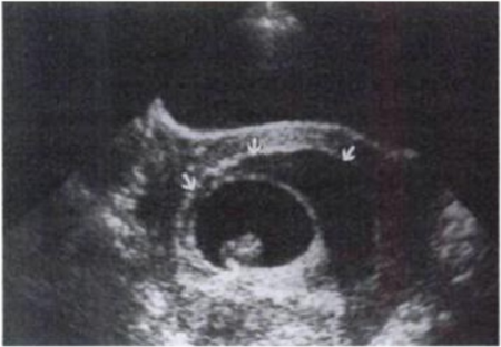 Subchorionic hematoma - WikEM