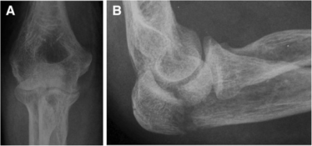 Olecranon fracture - WikEM
