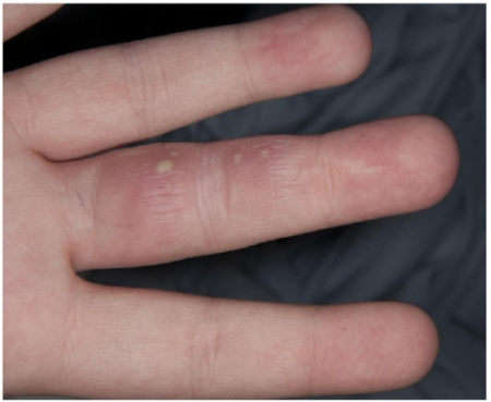 Herpetic whitlow - WikEM