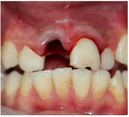 Dental avulsion - WikEM