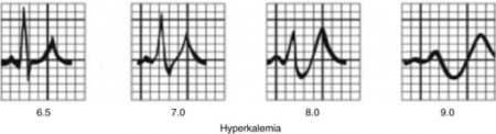 Hyperkalemia - WikEM