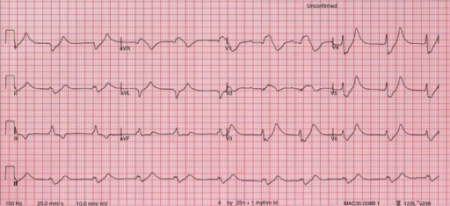 Hyperkalemia - WikEM