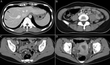 Fitz-Hugh-Curtis syndrome - WikEM
