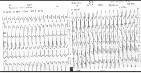 Idiopathic fascicular left ventricular tachycardia - WikEM