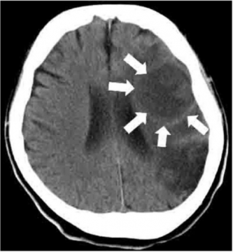 CT brain interpretation - WikEM