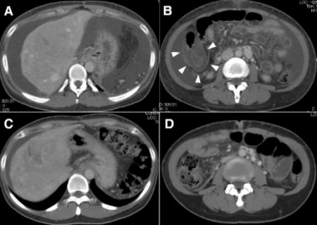 Spontaneous bacterial peritonitis - WikEM