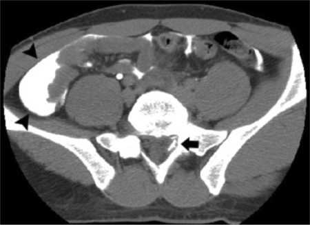 Bladder trauma - WikEM