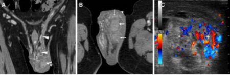 Epididymitis - WikEM