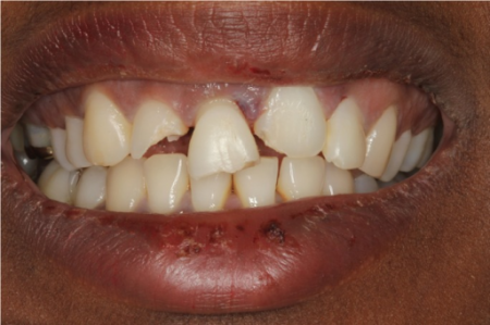 Dental subluxation - WikEM