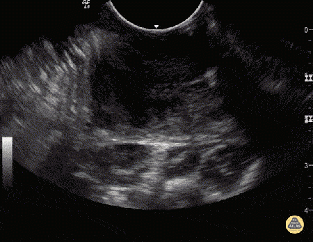 Peritonsillar abscess - WikEM