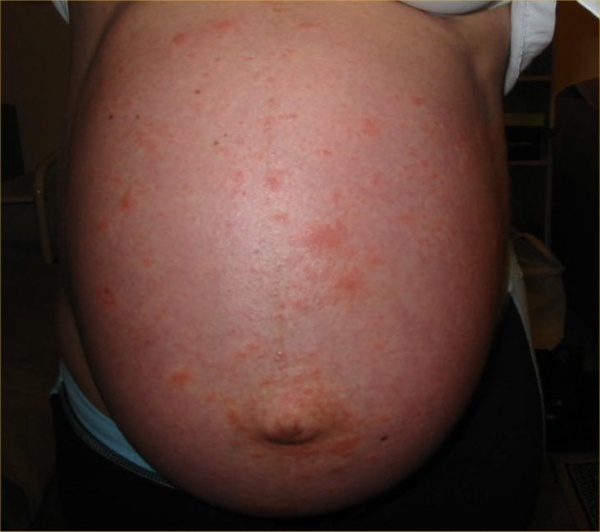 Rashes of pregnancy - WikEM