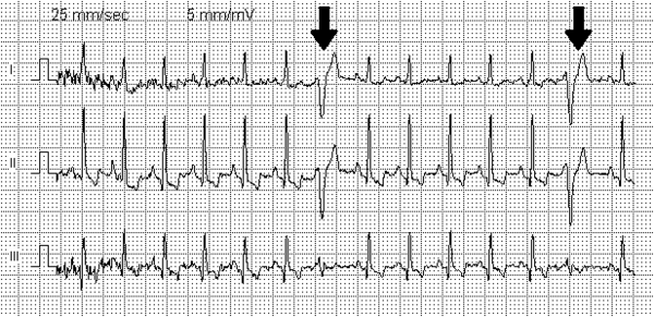 Premature ventricular contraction - WikEM