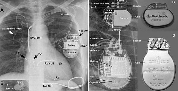 Pacemaker complication - WikEM