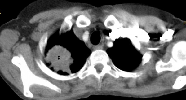Pancoast syndrome - WikEM