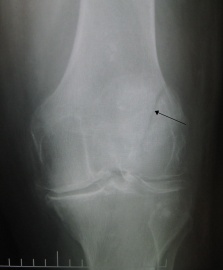 Knee x-rays - WikEM