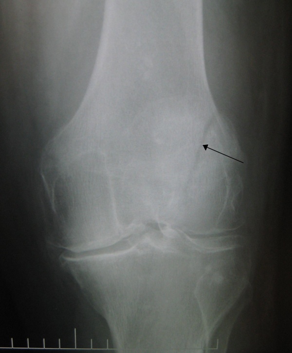 Patella fracture - WikEM