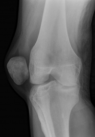 Knee x-rays - WikEM