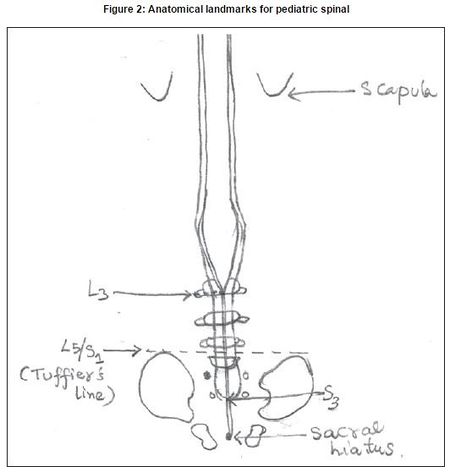 Lumbar puncture - WikEM