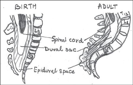 Lumbar puncture - WikEM