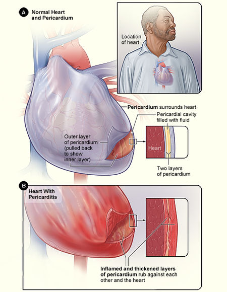 Pericarditis - WikEM