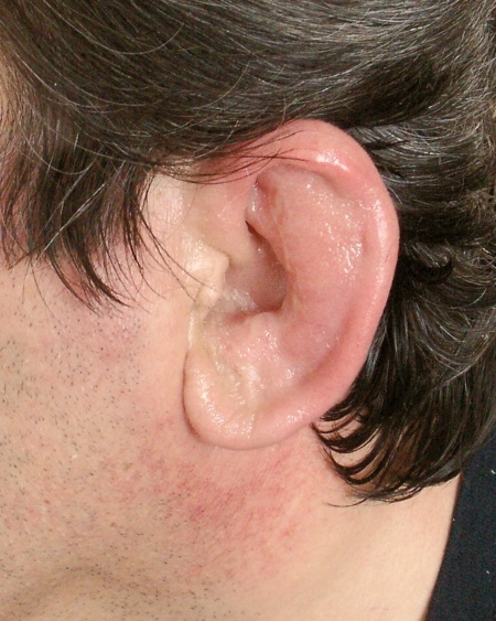 Auricular perichondritis - WikEM