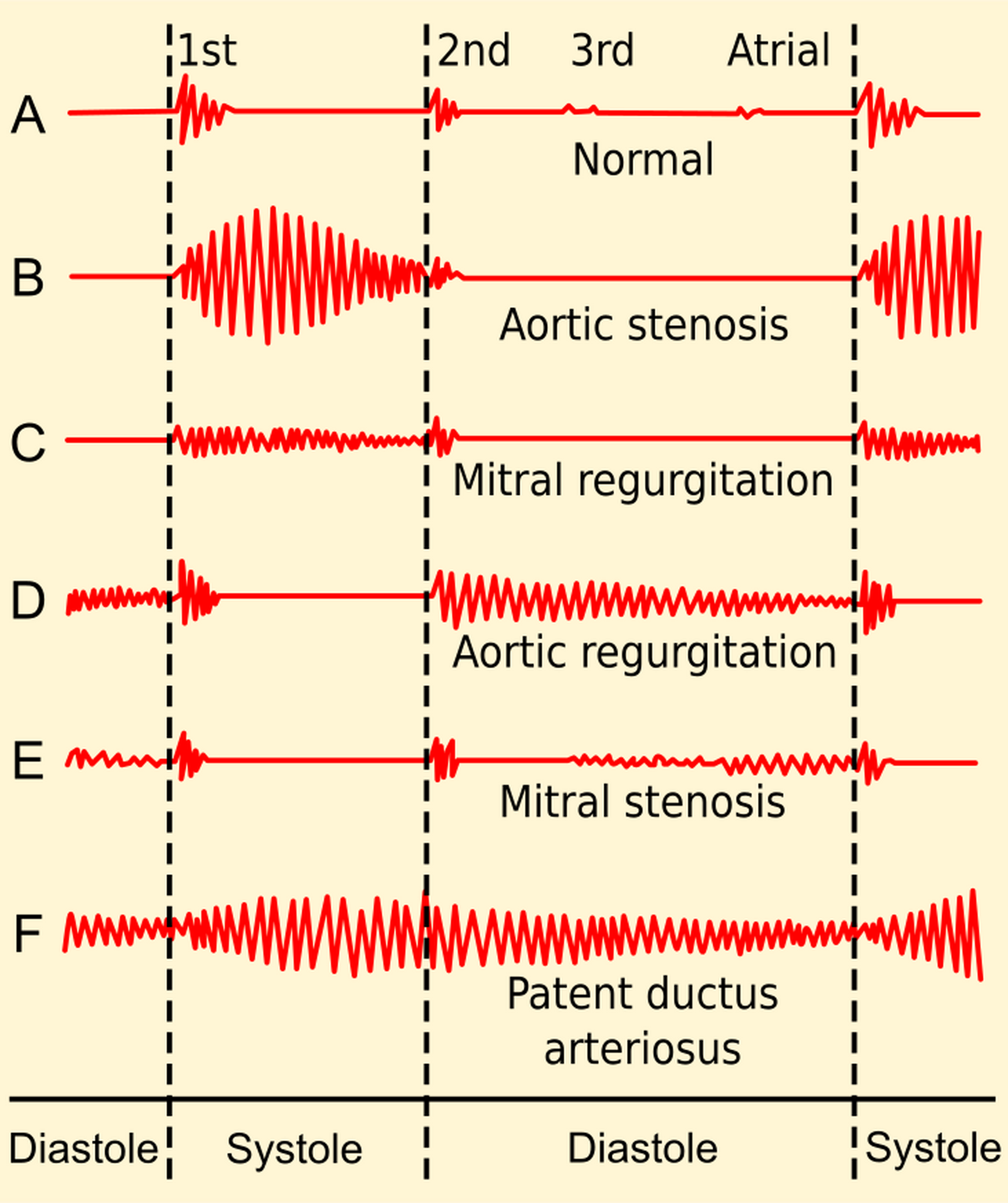 Filephonocardiograms From Normal And Abnormal Heart Soundssvg Wikem