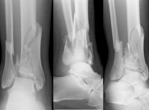 Distal leg fractures - WikEM