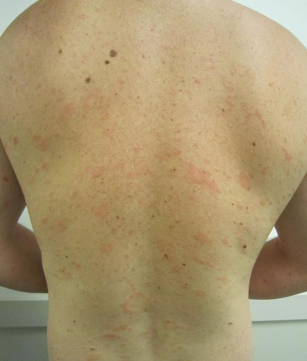 Pityriasis rosea - WikEM