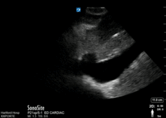 IVC ultrasound - WikEM