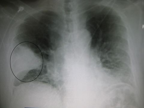 Chest x-ray interpretation - WikEM