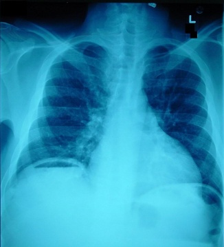 Chest x-ray interpretation - WikEM